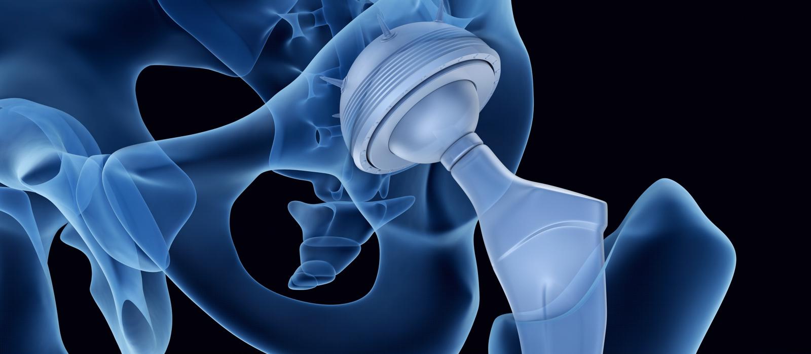 Boston Hip Replacement Lawsuit | $0 Legal Consultation Fees